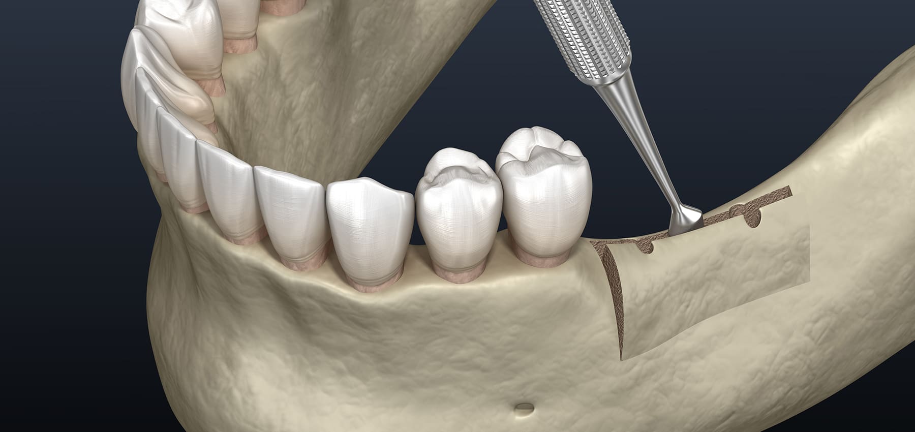 Alveoloplasty | Oral surgeon Harrisonburg & Staunton VA | Legacy Surgery