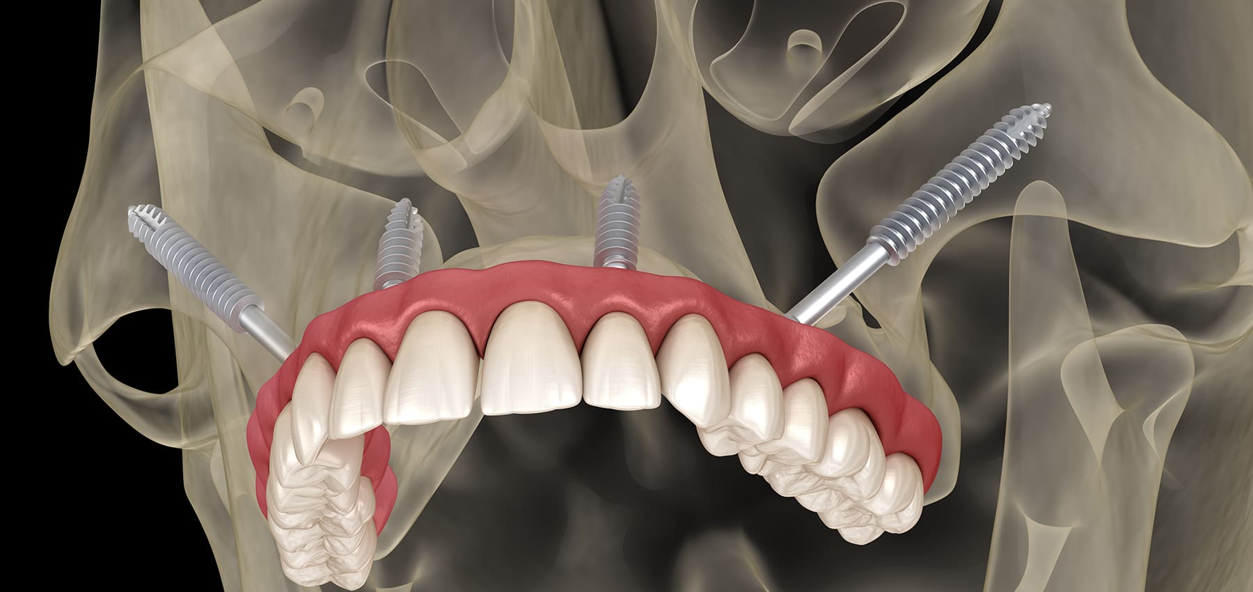 Zygomatic implants |Oral Surgeon Harrisonburg & Staunton VA | Legacy ...